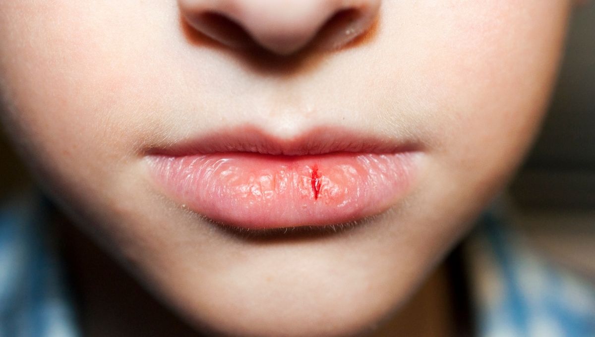 Labios secos: por qué se hacen así y cómo mantenerlos cuidados - Serzen